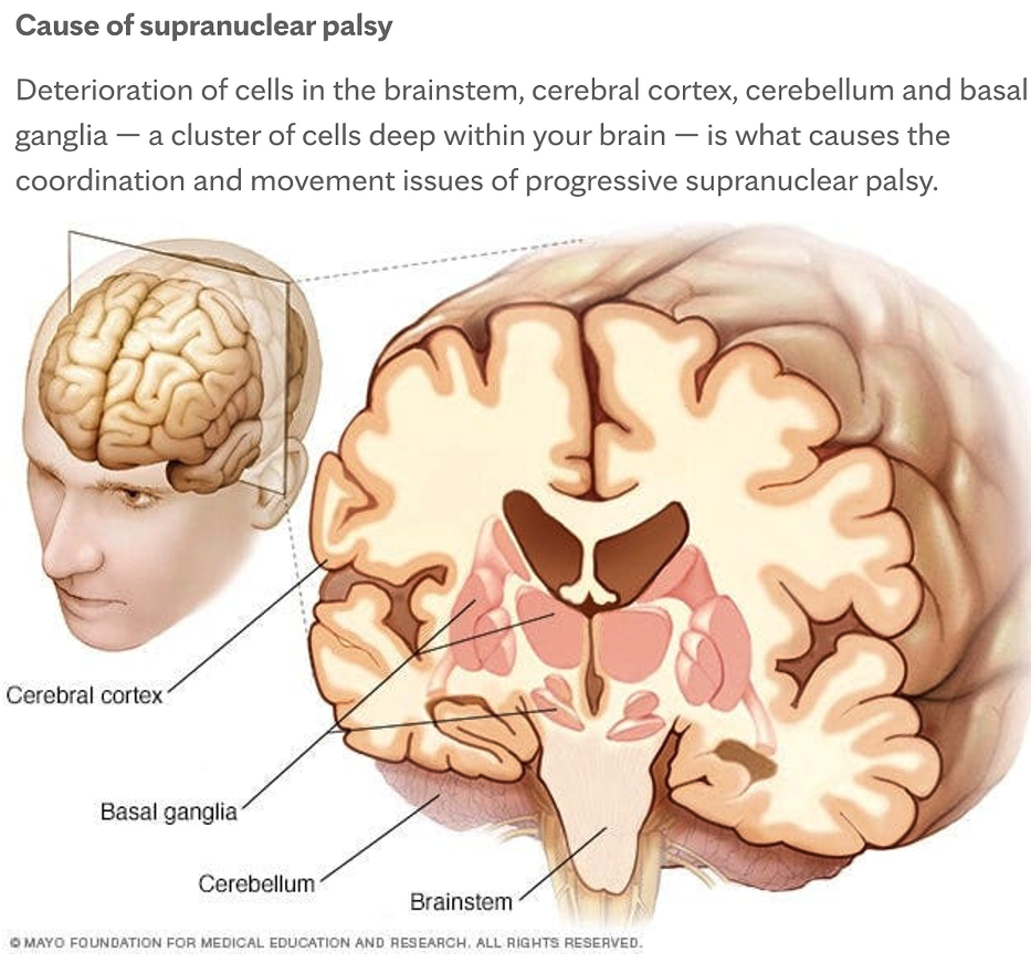 Progressive Supranuclear Palsy, a Neurological Disorder Described as ...