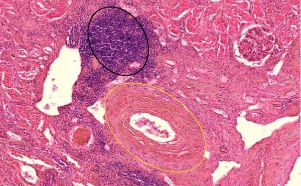Report 100: Pathological Basis of CoVax Disease Cardiovascular ...