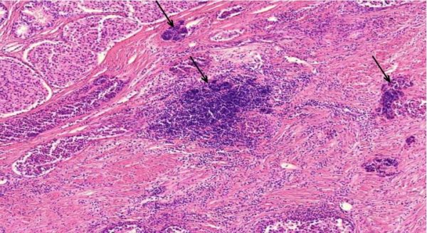 Report 100: Pathological Basis of CoVax Disease Cardiovascular ...
