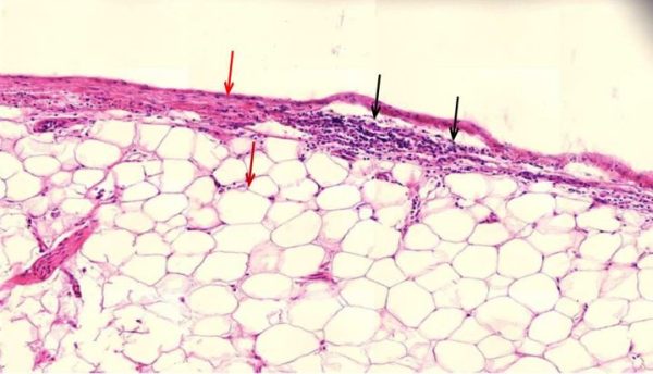 Report 100: Pathological Basis of CoVax Disease Cardiovascular ...